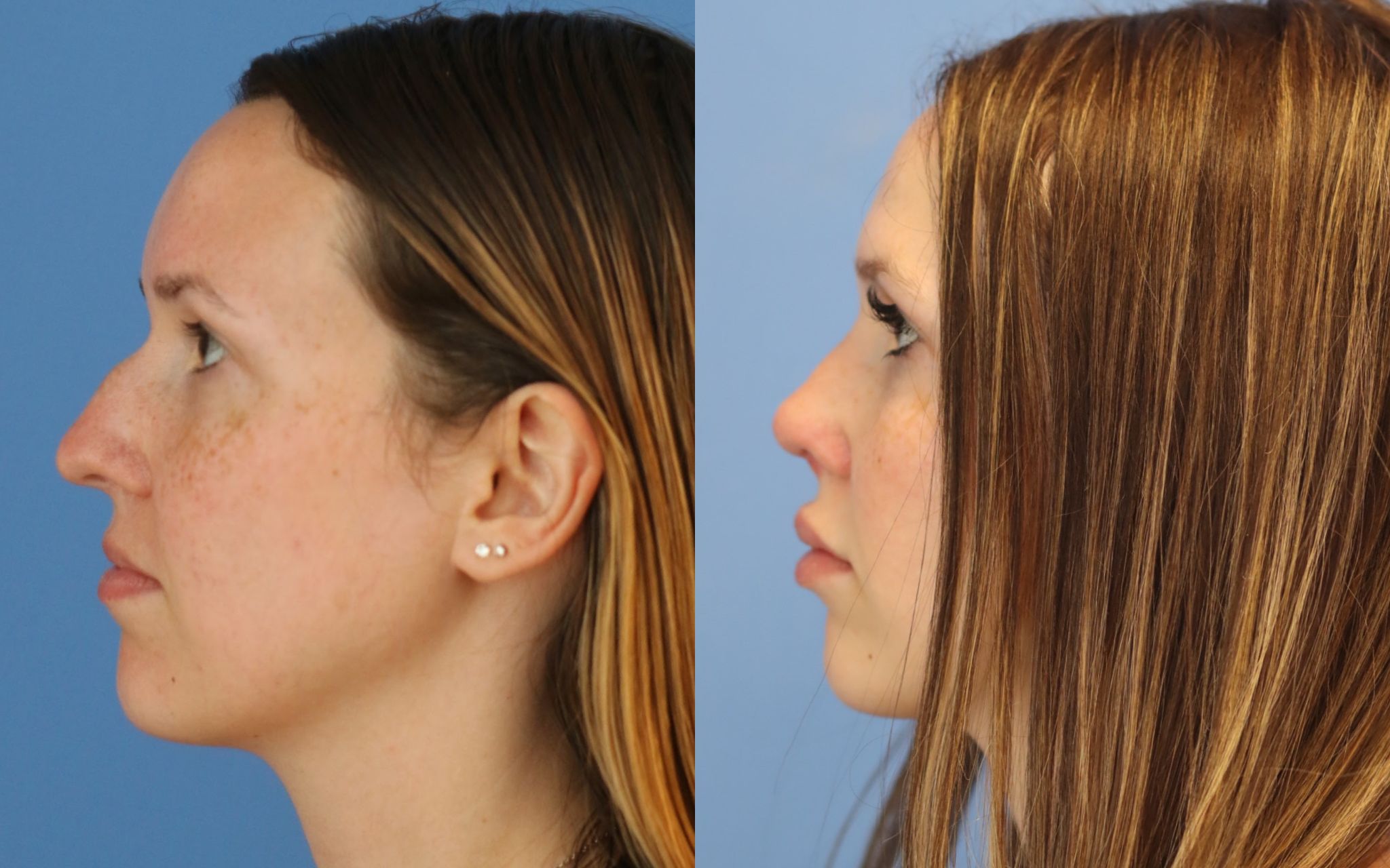 Rhinoplasty NJ - Enhance Your Profile | Kaplan Center